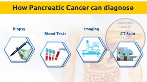 Pancreatic Cancer - Prolife Cancer Centre