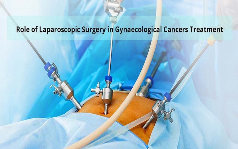 Role of Laparoscopic Surgery in Gynaecological Cancer Treatments
