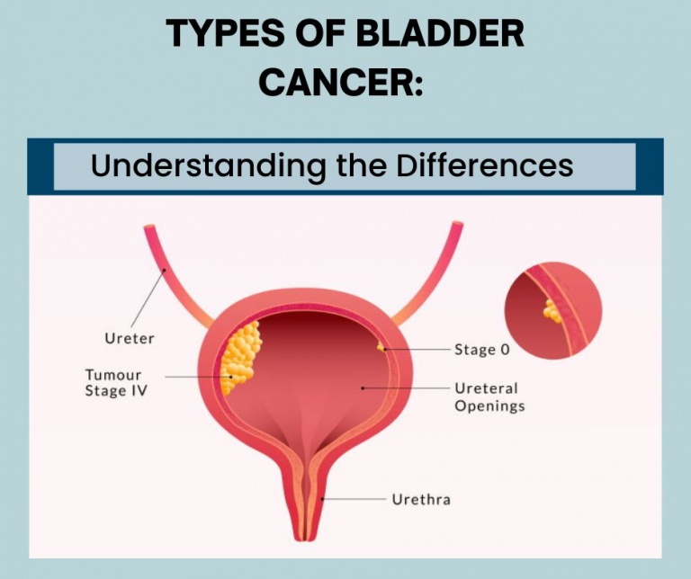 Types of Bladder Cancer: Understanding the Differences